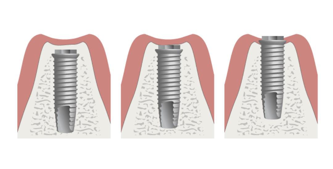 Which level of crestal bone should an implant be placed?